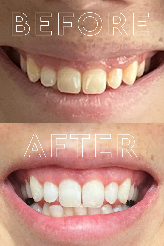 MOON Professional Teeth Whitening Kit - Platinum Pro Glow Teeth ...